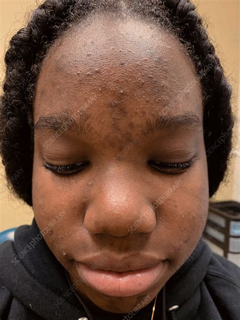 Pomade Acne Stock Image C056 0526 Science Photo Library