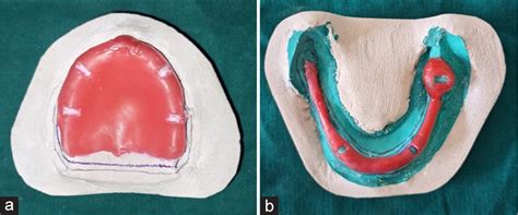 Cu Sil Denture A Novel Approach For The Preservation Of Teeth And Bone