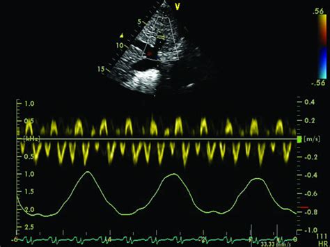Constrictive Pericarditis Respiratory Variation Of Doppler Curve Of Download Scientific