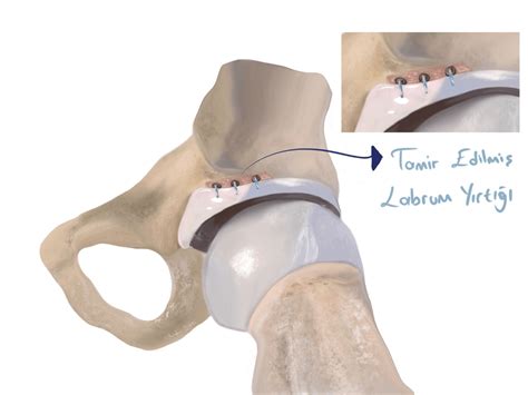 Hip Labral Tear Causes Symptoms And Treatment