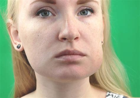 What Is A Hematoma After Wisdom Tooth Extraction At Sharon Park Blog