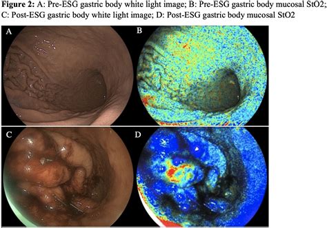 Management Of Patients After Failed Gastric Peroral Endoscopic Myotomy