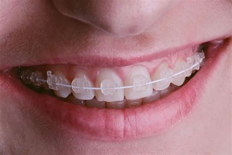 Ортодонтия Ортодонтско лечение Ортодонт Стара Загора