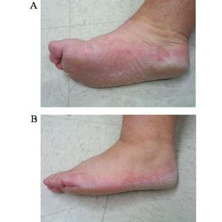 Pdf Dermatology For The Practicing Allergist Tinea Pedis And Its