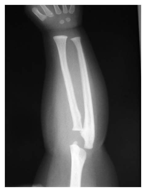Hypoplasia And Subluxation Of The Head Of The Radius Download