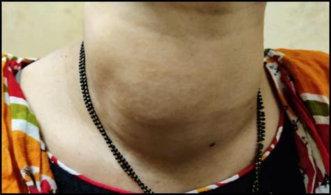 Photograph Of Anterior Neck Swelling In Patient Download Scientific Diagram