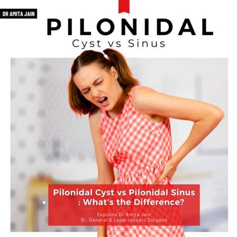 Pilonidal Cyst Vs Pilonidal Sinus How Do They Differ
