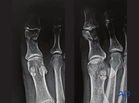 Complete Articular Fractures Of The Proximal Hallux