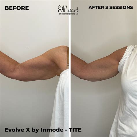 Evolvex San Diego Evolvex Body Contouring Evolvex Treatment
