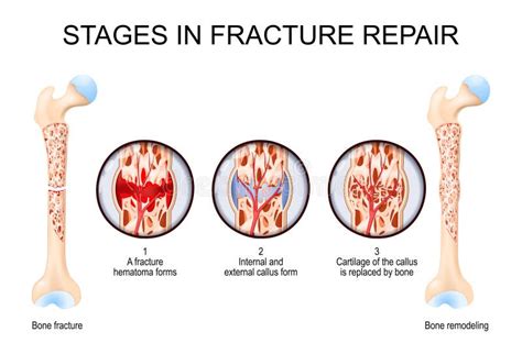 Stages In Fracture Repair From Bone Fracture To Bone Remodeling Stock