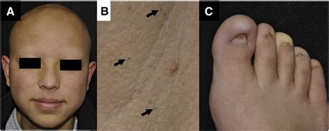 Hoxc13 Causing Pure Hair And Nail Ectodermal Dysplasia Syndrome A