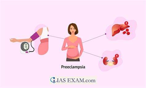 Pre Eclampsia Ensuring Safe Motherhood