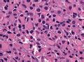 Diffuse Astrocytoma Libre Pathology