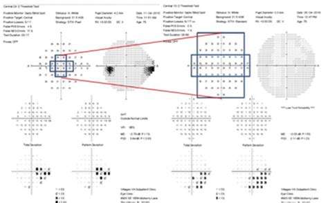 Computerized Visual Field Testing PablorosCole