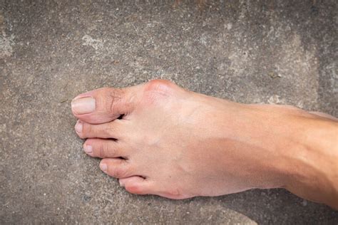 Россиян предупредили о последствиях «безобидной шишки на ноге Газета Ru Новости