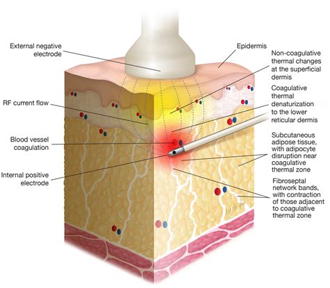 Introduction And Overview Of Radiofrequency Treatments In Aesthetic