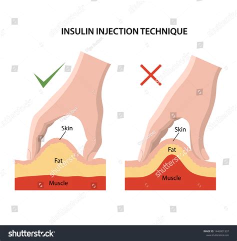 Insulin Injection Technique Diabetes Correct Incorrect 库存矢量图（免版税）1446001337 Shutterstock