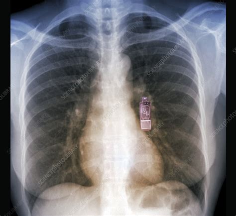 Cardiac Monitoring Device Chest X Ray Stock Image C0403126