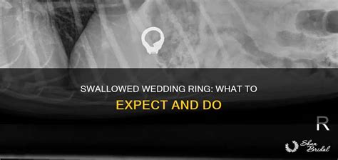 Swallowed Wedding Ring What To Expect And Do Shunbridal