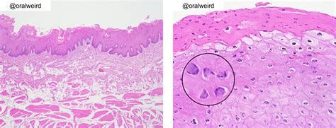 Hairy Leukoplakia Histology