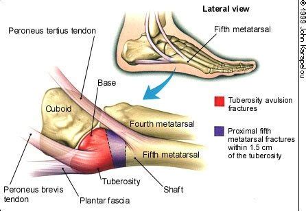 Fifth Metatarsal Fracture Treatment And Tips Metatarsal Fractures