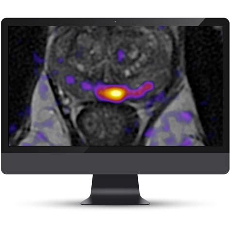 Understanding Cpt Codes For Prostate Mri Analysis Cortechs Ai