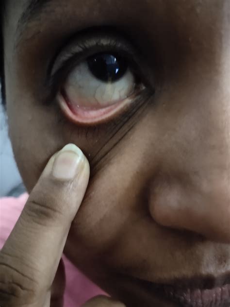 Conjunctivasegmentation Instance Segmentation Model By Hemoglobin