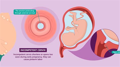 What Happens To Your Cervix During Labor Or Birth Being The Parent