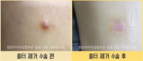 다리의 튀어 나온 흉 제거 수술 15주 후 흉터치료 전후 청담아이비성형외과