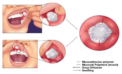 Design Of Buccal Mucoadhesive Tablets Pharma Excipients