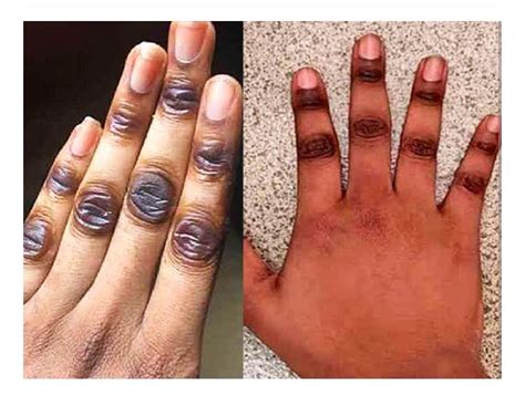 Dark Knuckles Causes And Remedies For Hyperpigmentation √√ The Scoper Media The Scoper Media