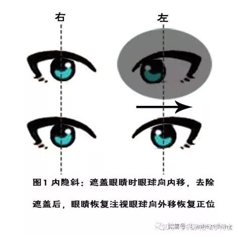 招飞体检眼科遮盖试验间歇性斜视和隐斜视 知乎