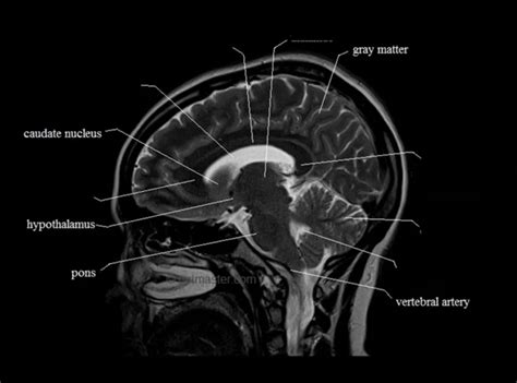 Diagram Sagittal Brain Mri Diagram Quizlet