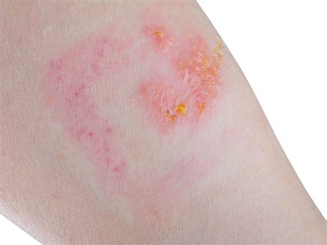9 Home Remedies To Reduce Rashes On Inner Thighs