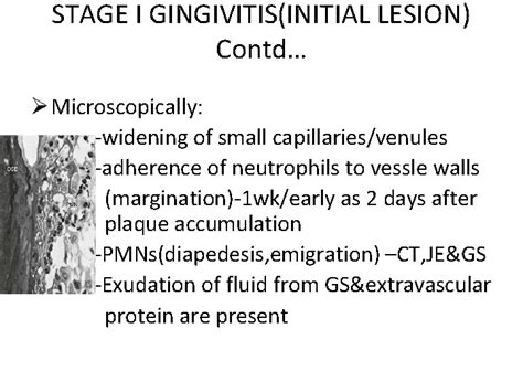 Gingival Inflammation Introduction Stage I Gingivitisinitial Lesion Stage
