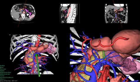 Endoscopic 3d Modeling Image Solutions Fujifilm Healthcare