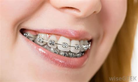 Teeth Alignment With Braces Dentist Downers Grove General
