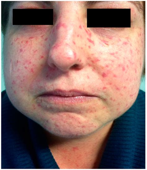 Ijms Free Full Text Orofacial Manifestations And Temporomandibular