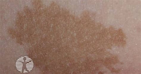 Dermnet® Congenital Naevus Image Dermnet® Congenital Naevus Image