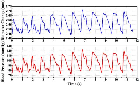 Continuous Monitoring Of Radial Artery Diameter And Estimated