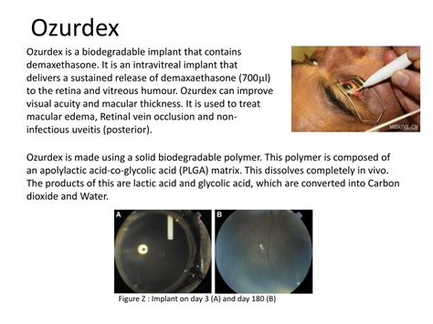 Ppt Ozurdex Powerpoint Presentation Free Download Id 2779997
