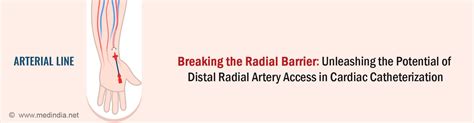 Comparing Distal Vs Proximal Radial Artery Access Findings Show