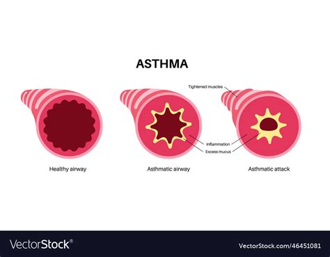 Asthma Lung Disease Royalty Free Vector Image Vectorstock