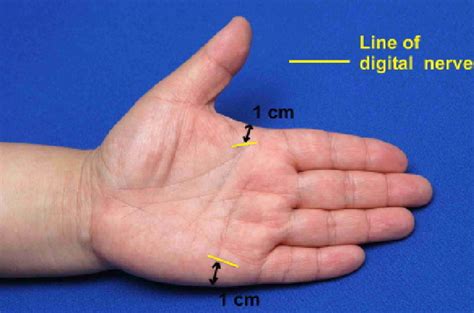 Intermetacarpal Blocks