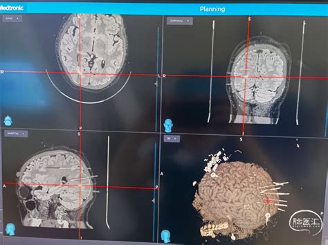 温医一院神经外科病例分享（20）：手术机器人辅助下利用立体定向脑电图seeg技术治疗难治性癫痫1例 脑医汇