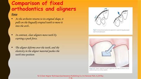 CLEAR ALIGNER THERAPY IN ORTHODONTICS Pptx Oral Care Personal Care