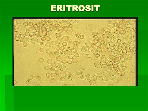 Detail Gambar Eritrosit Pada Urine Koleksi Nomer 14