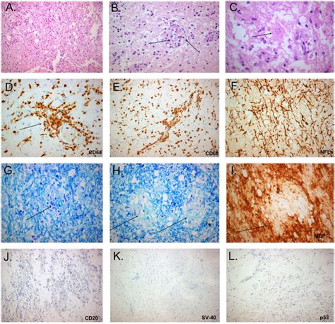 Recurrent Fulminant Tumefactive Demyelination With Marburg Like Features And Atypical