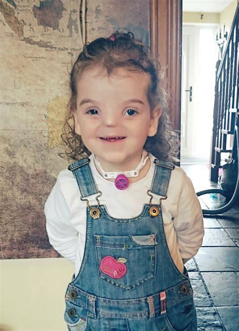 Irish Mum Reveals Guilt She Feels As Daughter Was Born Without A Nose