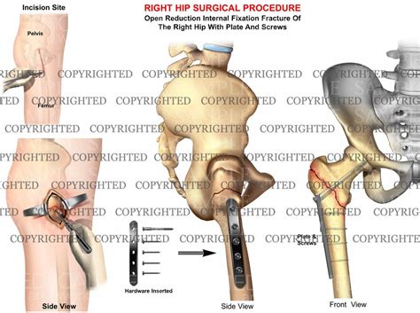 Open Reduction Internal Fixation Hip